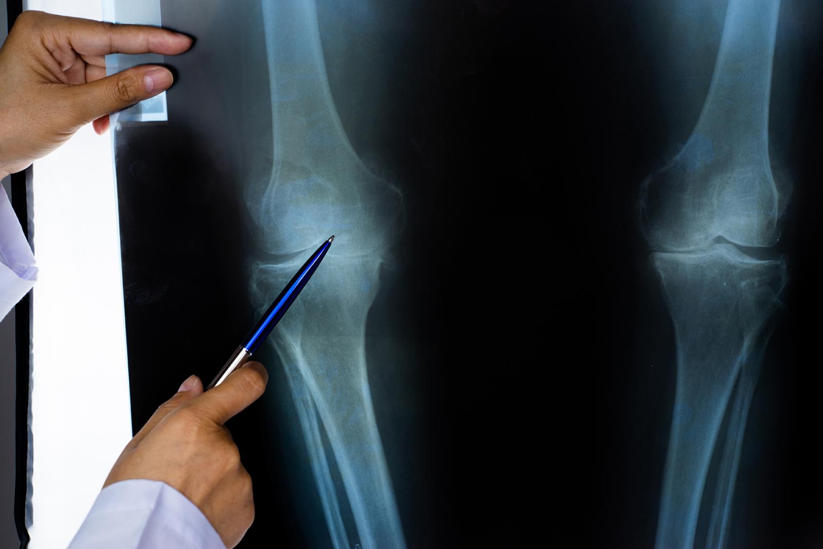 Hip and Knee Pathway | SaskHealthAuthority